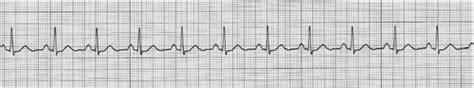 Ecg Rhythm Identification Flashcards Quizlet