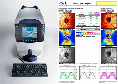What Is A Gdx Eye Test At Robin Gloria Blog