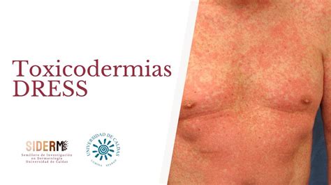 Revisión Toxicodermias Dress Youtube