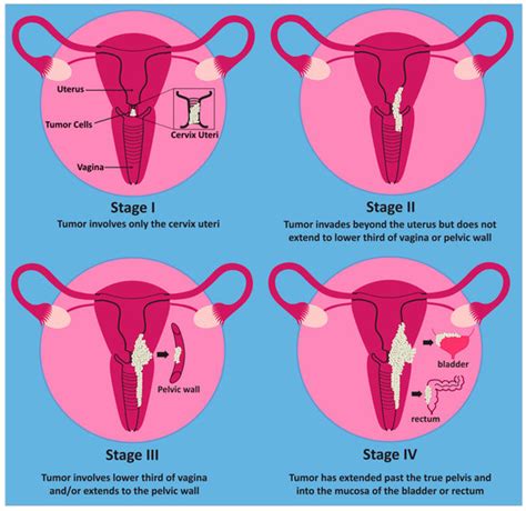 Early Stages Of Female Genital Herpes