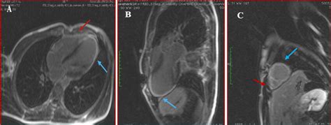 Phase Sensitive Inversion Recuperation Mri Sequences Revealing
