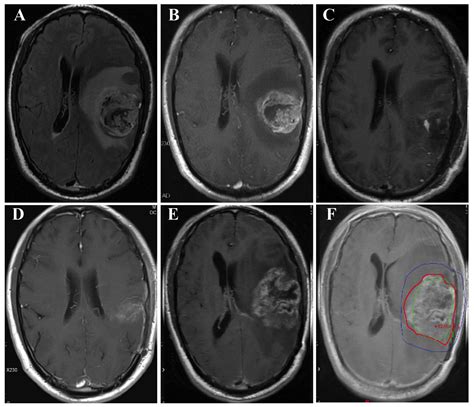 Ai Driven Classification Of Diffuse Gliomas Skips Molecular Testing