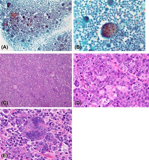 Multinucleated Giant Cells
