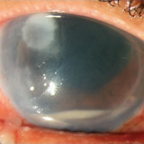 Late Infective Keratitis With Interface Hypopyon Download Scientific