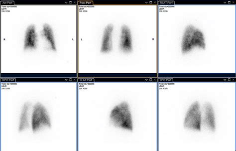Scintigraphy Showing Non Specific Diffuse Perfusion Defects Download Scientific Diagram