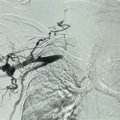 Peripheral Angioplasty Test Cost In Ludhiana India Peripheral