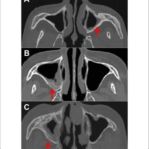 Pdf Computed Tomography Evaluation Of Unilateral Chronic Maxillary Sinusitis With Osteitis