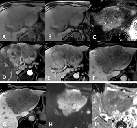 The Targetoid Appearance Of Eob Mri In Differentiating Mass Forming Intrahepatic