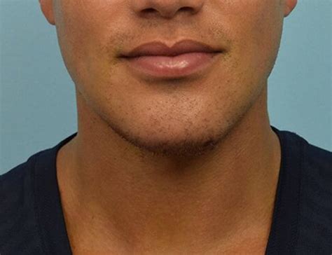 Before And After Chin Implants Bellaire Face Forward