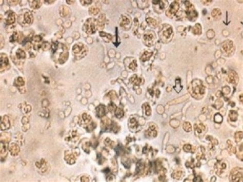 Atlas De Sedimento Urinario Urinarios Sedimentarias Eritrocitos