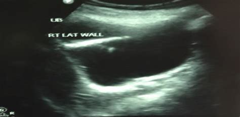 A Ultrasonography Of Pelvis Showing Linear Echogenic Density