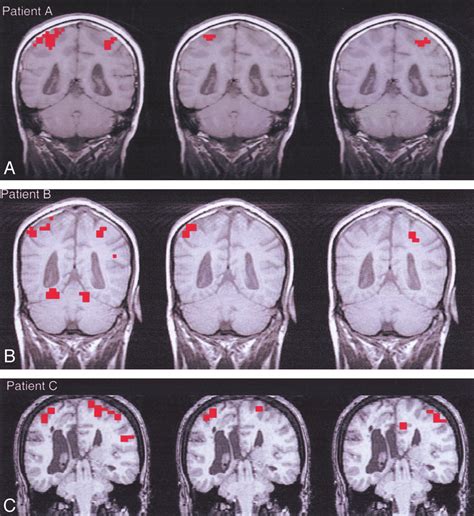 Functional Connectivity And Activation In The Sensorimotor Cortex Of Download Scientific