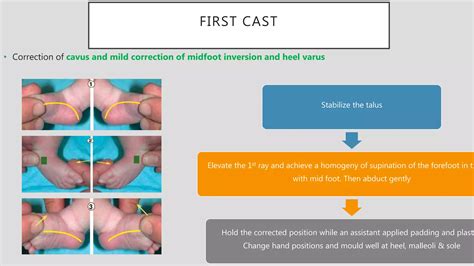 Ctev Assessment And Ponseti Technique Pptx