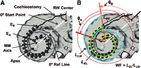 Ct Derived Image Of A Participants Electrode Array Contour Advance
