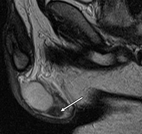 Spectrum Of Extratesticular And Testicular Pathologic Conditions At Scrotal Mr Imaging