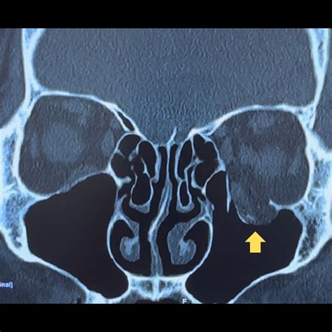 Orbital Fractures Causes Risks And Treatment Explained