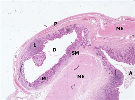 Diverticulosis Histology