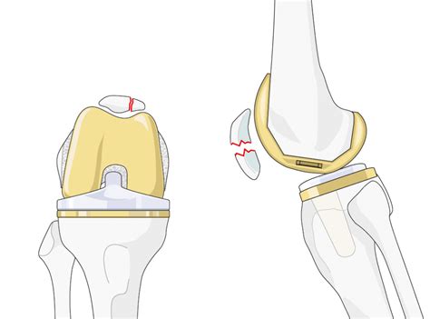 Patella Fracture Causes Symptoms And Treatment Options