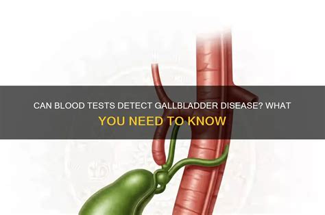 Can Blood Tests Detect Gallbladder Disease What You Need To Know Medshun