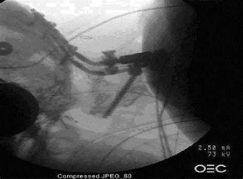 Intraoperative Fluoroscopy Of The Lateral Cervical Spine Download