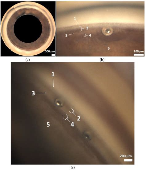 Jcm Free Full Text Position Of The Istent Inject® Trabecular Micro