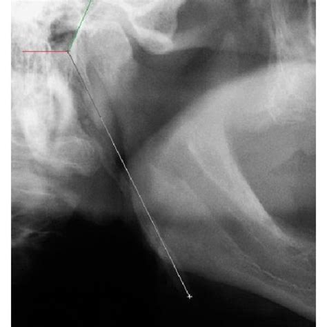 A Panoramic Radiography Showing The Elongated Styloid Process B