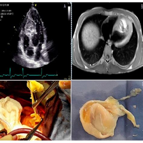 Pdf The Interventricular Septum Structure Function Dysfunction