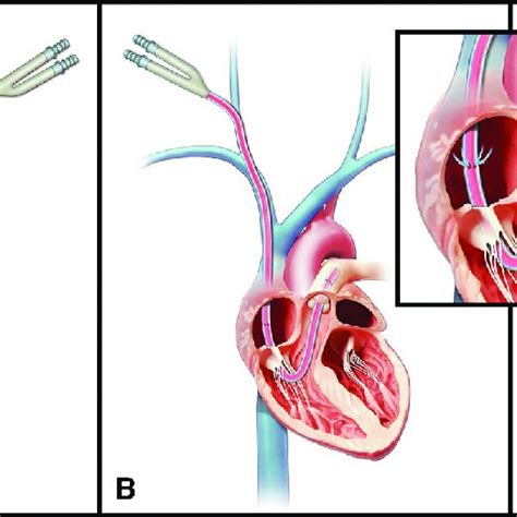 A Dual Lumen Bicaval Vv Ecmo Cannula Percutaneously Placed In The