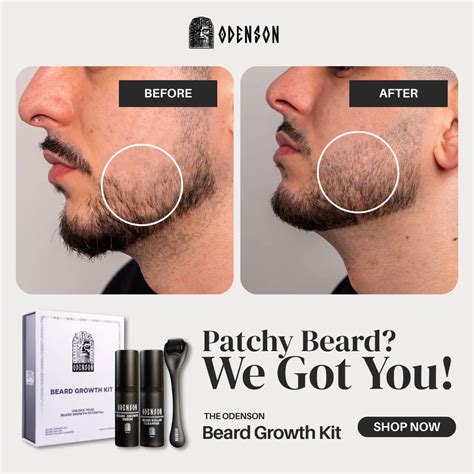 Beard Growth Kit For Men Thicker Fuller Beard With Serum And Roller