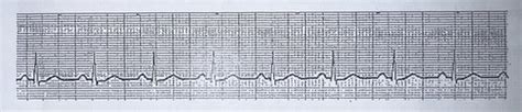 Ekg Rhythms Flashcards Quizlet