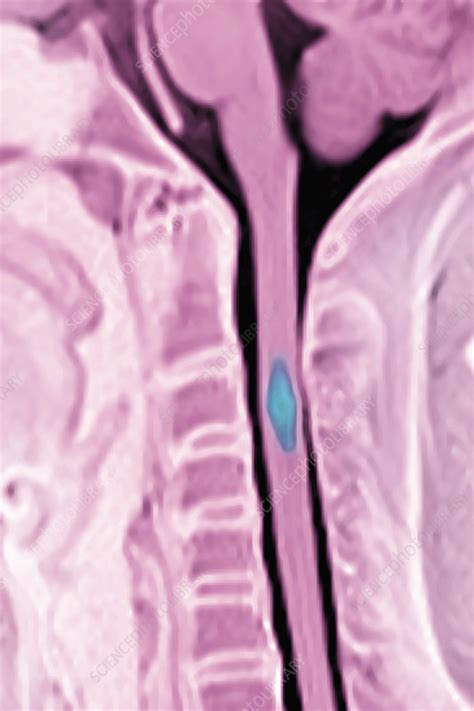 Multiple Sclerosis Mri Stock Image C0584683 Science Photo Library