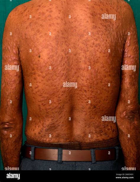 Not For Use In Television Not For Use In Television Diffuse Cutaneous Leishmaniasis Man With A