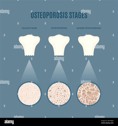Osteoporosis Bone Density Loss Disease Medical Infographics Stock