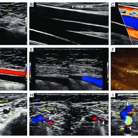 A Transverse View Color Doppler Us Of The Left Common Femoral Vein