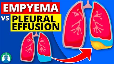 Empyema Vs Pleural Effusion Explained Youtube