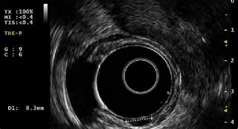 Figure 2 From Cap Assisted Endoscopic Mucosal Resection For Rectal Neuroendocrine Tumors An