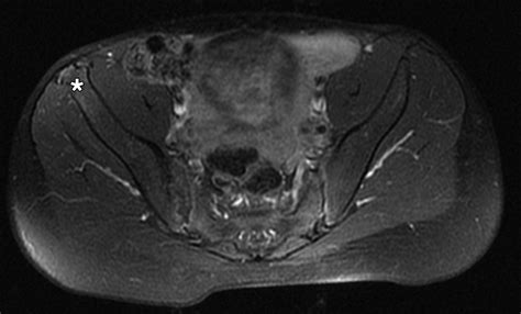 Imaging Findings Of Lower Limb Apophysitis Ajr