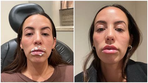 I Got My Lip Filler Dissolved See Photos Ps Beauty