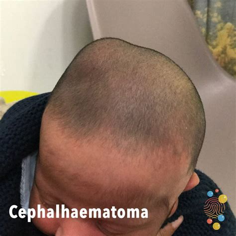 Cephalhaematoma Skin Deep