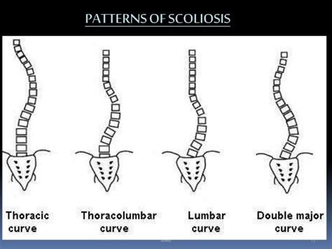 Scoliosis