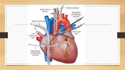 Cardioplegia Cannulapptx