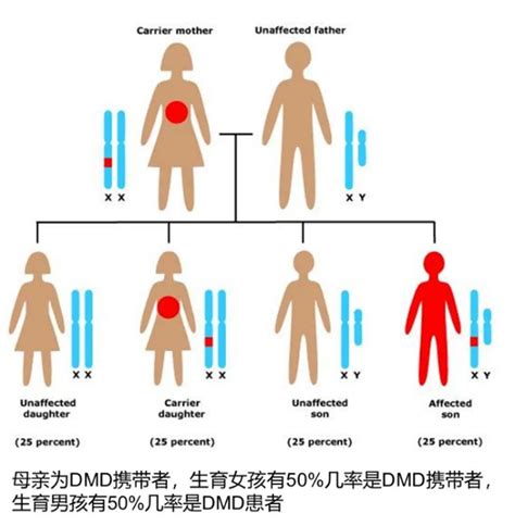 基因解遗 一文认识传男不传女的遗传病杜氏肌营养不良 知乎