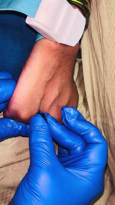 How To Insert Scalp Set Procedure S V Set Fixation Training Shorts Views Reels Nurse