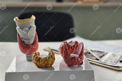 Hyperthyroidism And Overactive Thyroid Gland Thyroid Lymphoma Closeup Stock Image Image Of