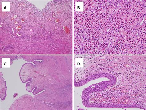 Histologic Findings Of Partial Cystectomy Specimen A Low Magnification