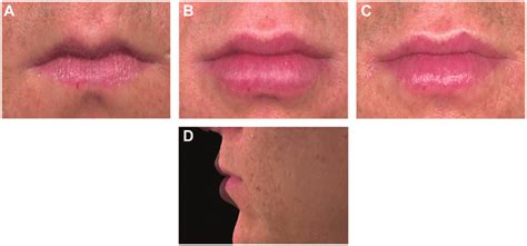 Why Do Guys Have Small Lips