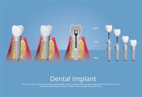 인간의 치아와 치과 임플란트 벡터 일러스트 레이 션 무료 벡터