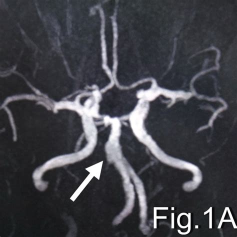 A C Show The Mra Cta And 3d Dsa Respectively Of The Anterior Download Scientific Diagram