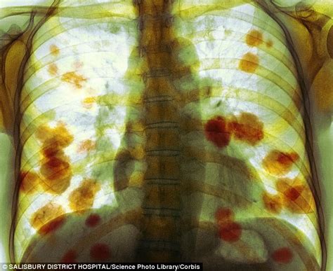 Us Cancer Death Rates Fall 20 Percent In The Last 20 Years Mostly Thanks To Americans