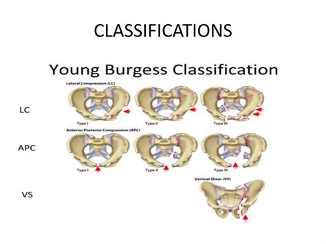 Pelvic Fractures Pptx